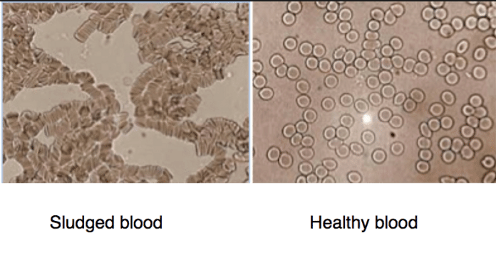 Do you suffer from intravascular agglutination?